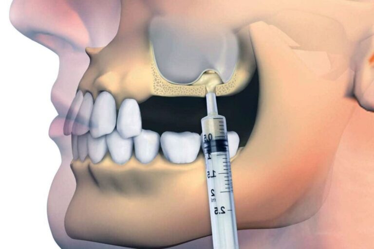 Sinus Lift – Smile Center
