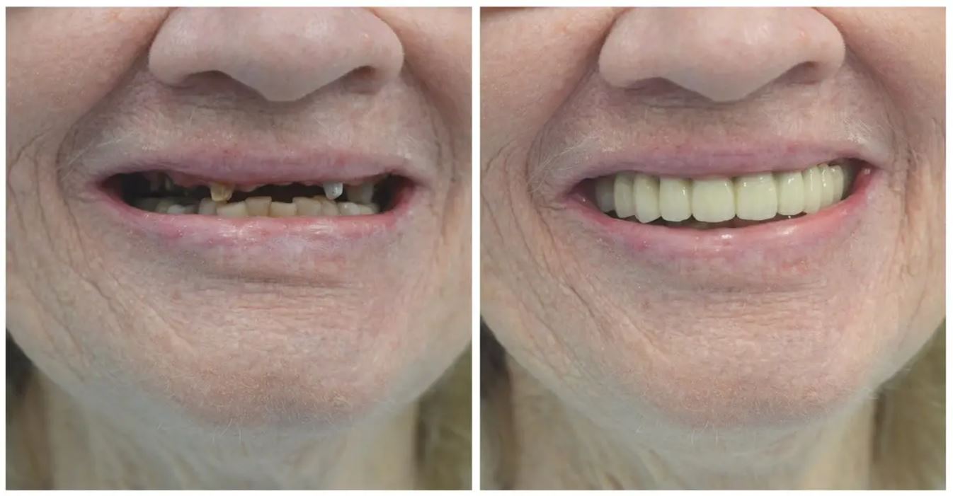 Dental Bridge – Smile Center